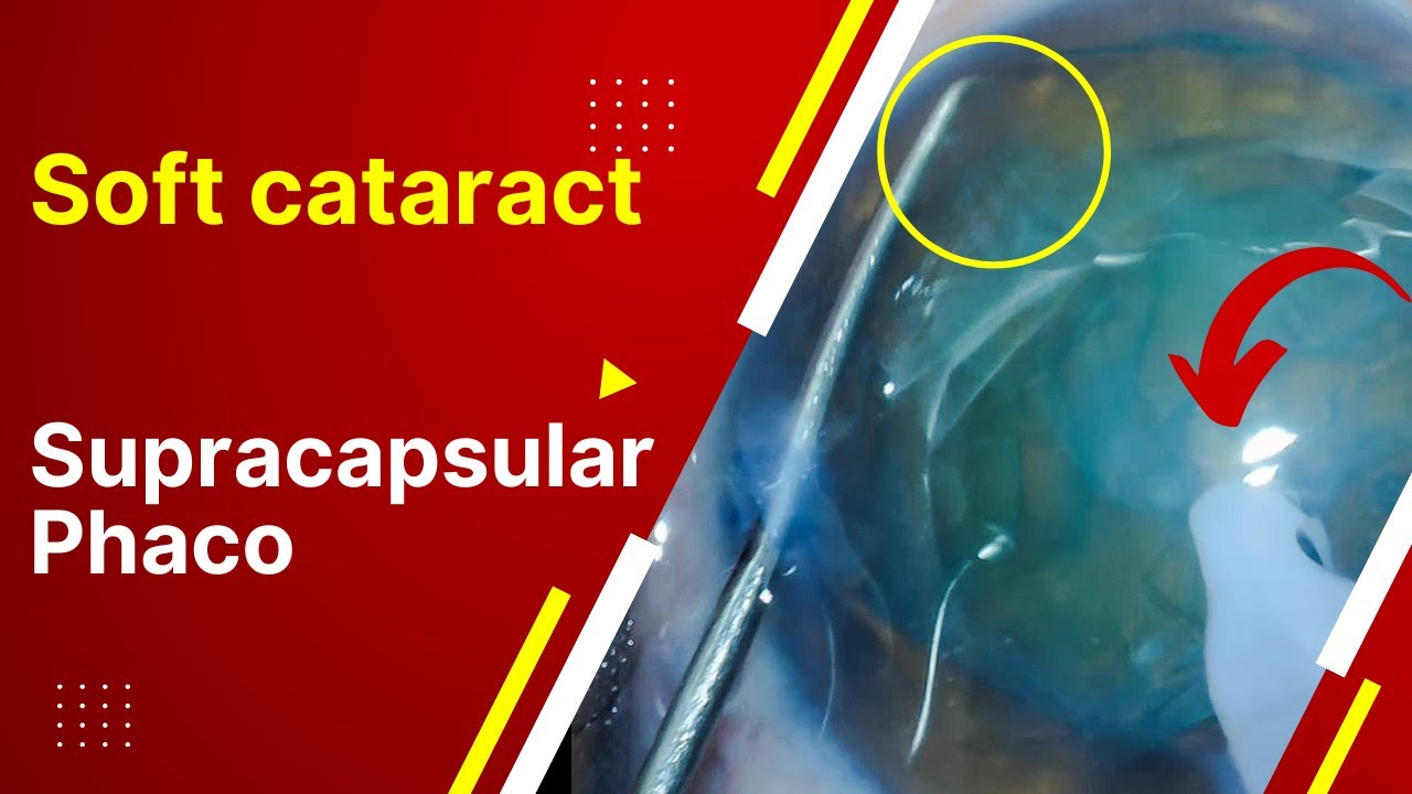 Case series 30. Soft cataract supracapsular phaco, tilt and tumble ...