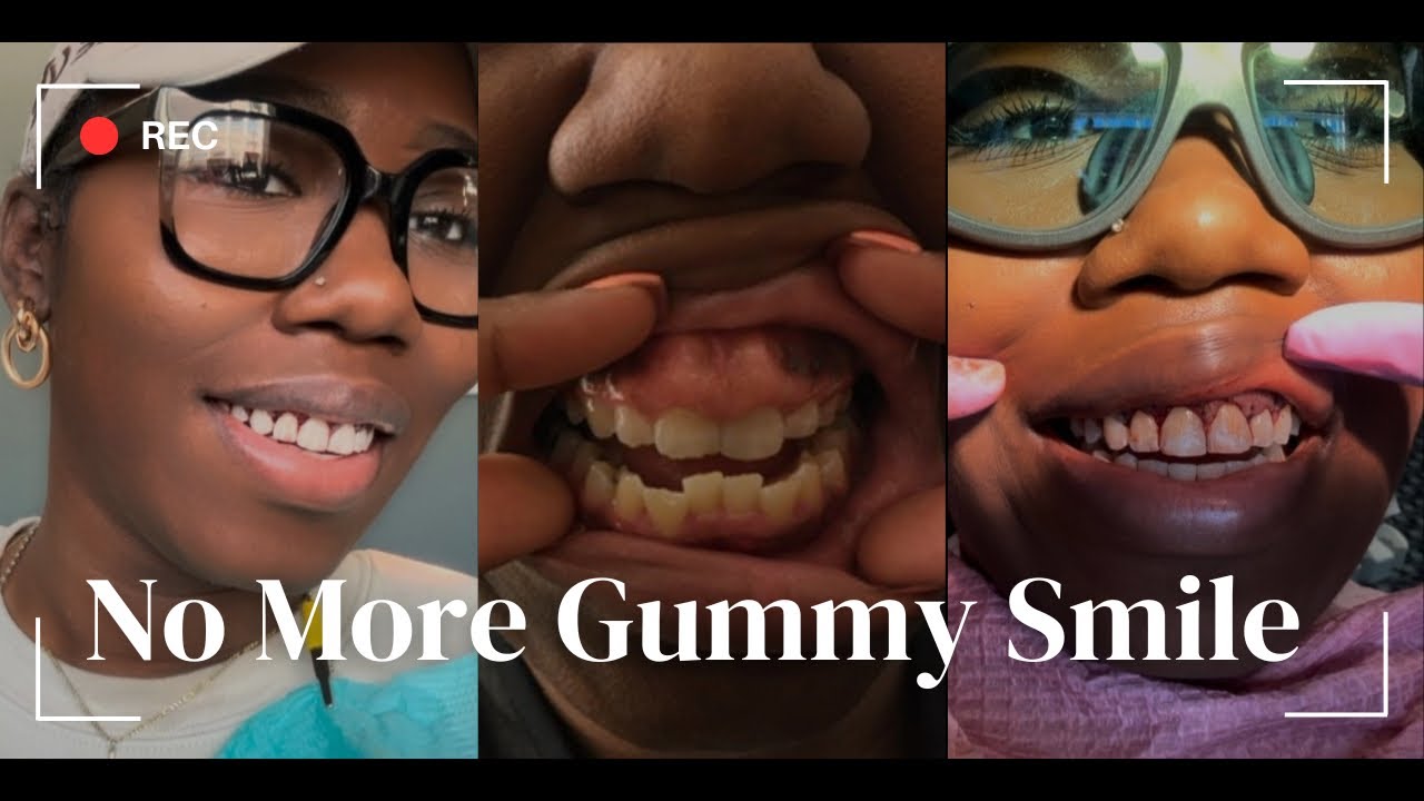 #VLOG My Smile Transformation: Gum Surgery, Braces & Healing (Graphic ...
