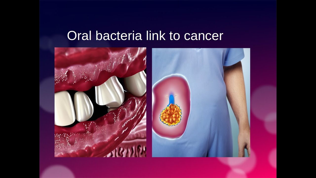 Bacteria associates with colorectal cancer | oral | mouth ...