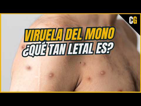 Viruela Símica / del Mono - Letalidad, Sintomas y Vías de Contagio de la Mpox Explicados