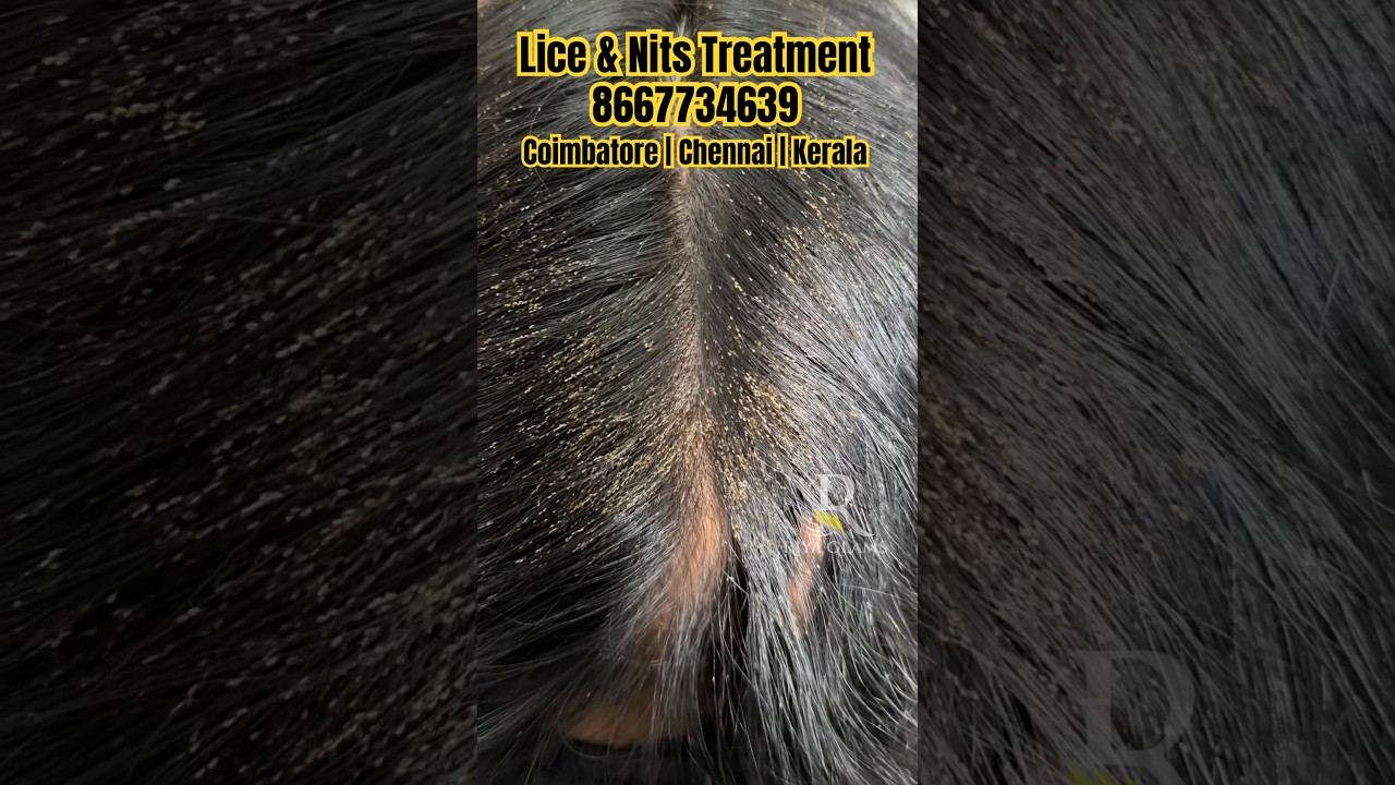 Lice nits removal treatment | lice treatment | lice removal | lice how ...