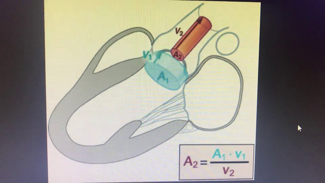 Aortic stenosis-continuity equation - YouTube