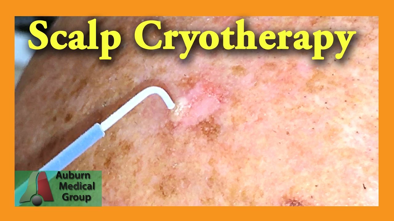 Scalp Cryotherapy | Auburn Medical Group - YouTube