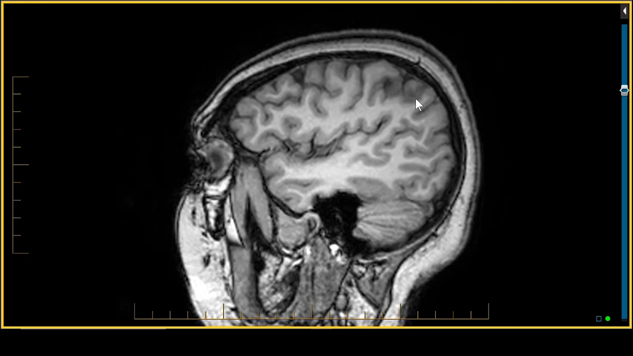 Inferior Parietal Lobule Mri
