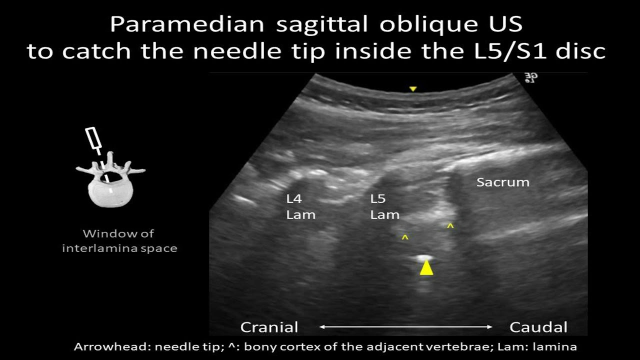 US-guided lumbar intradiscal injection for discogenic pain ...