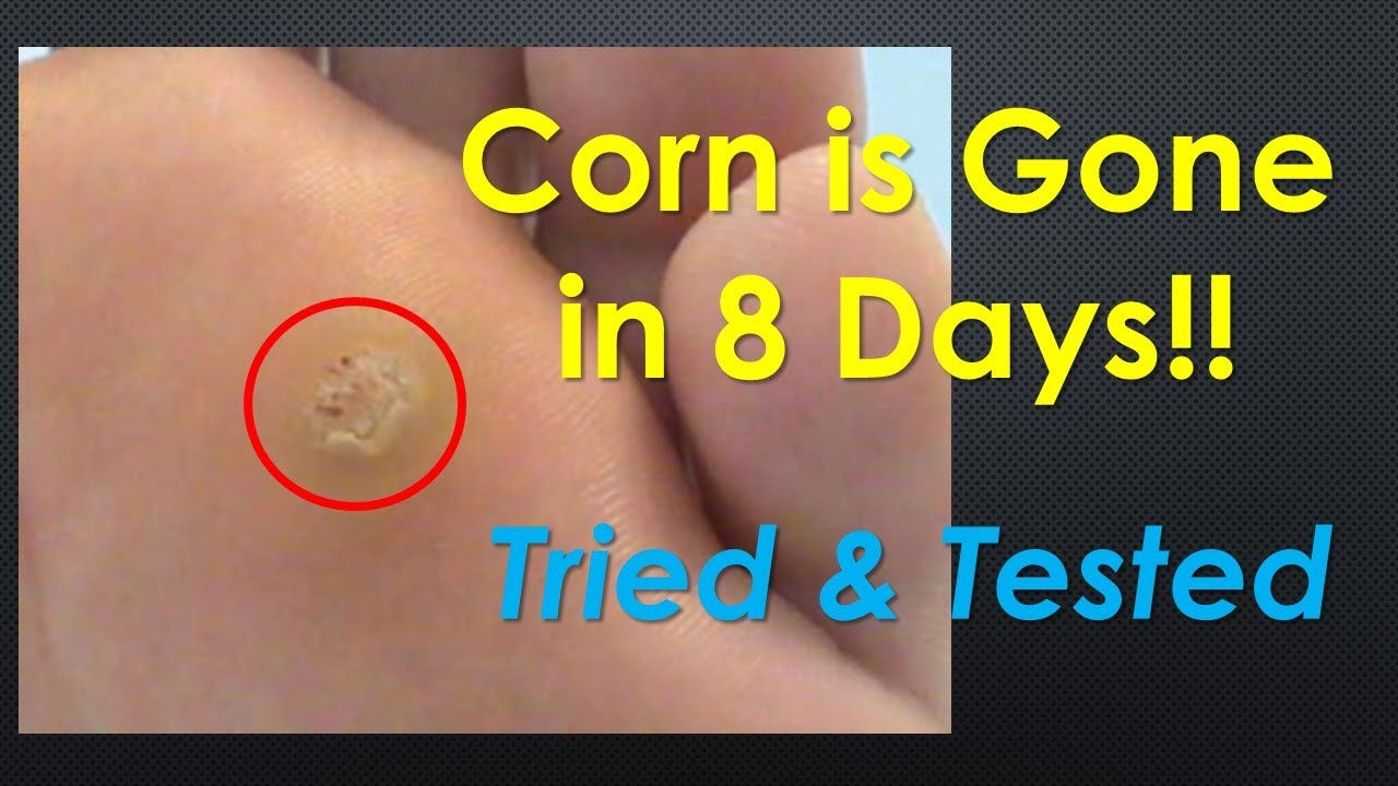 Corn removal in 8 Days | Tried & Tested | Corn on foot removal at home ...