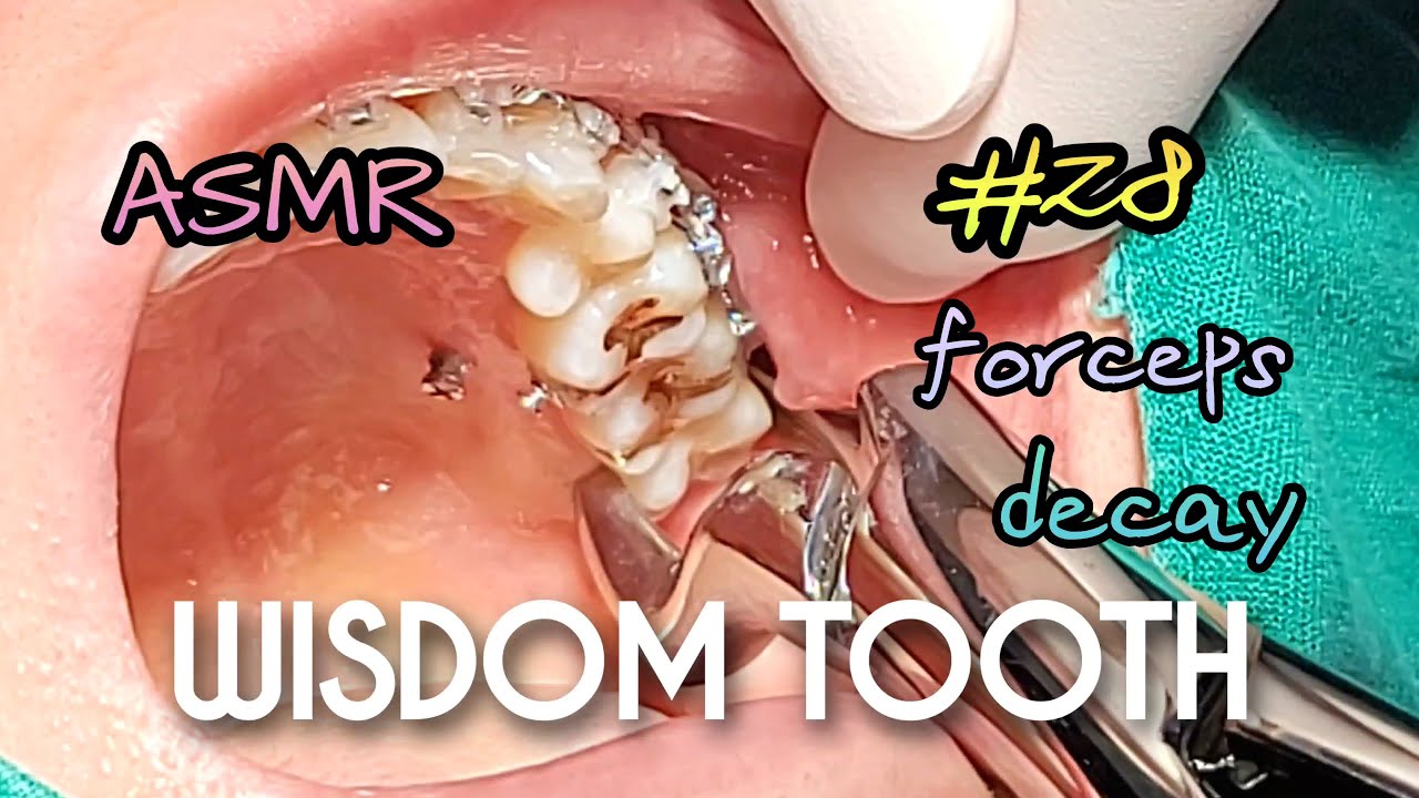 [ASMR] Wisdom Tooth Extraction in 40 Seconds - YouTube