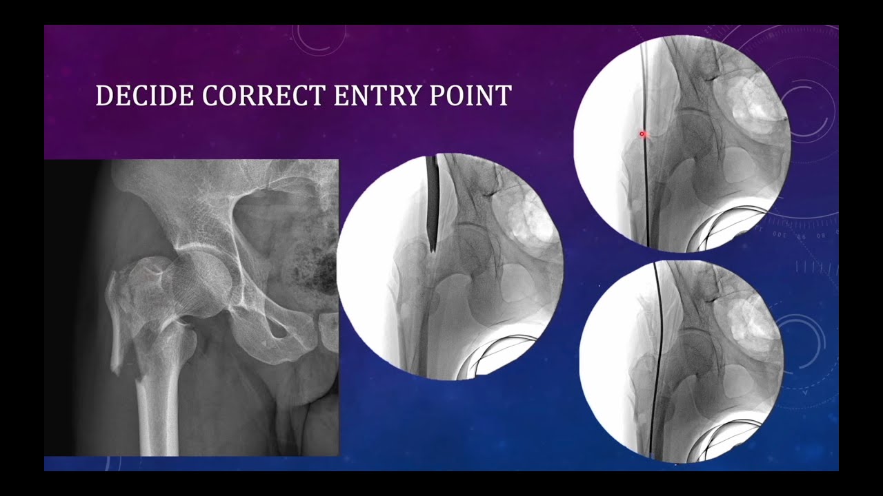 Basic technical tips for nailing of trochanteric /IT femur fractures ...