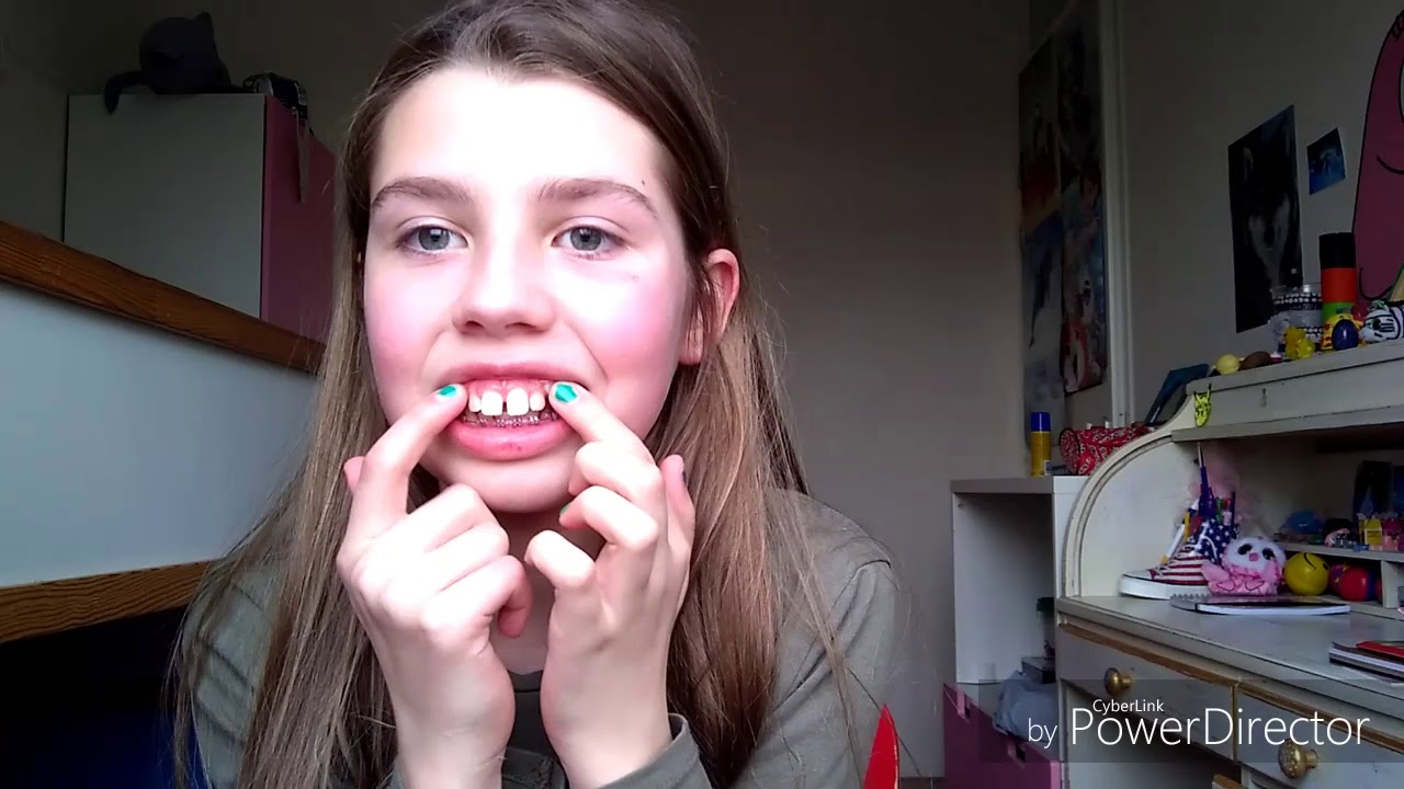 Mijn beugel | story time | - YouTube