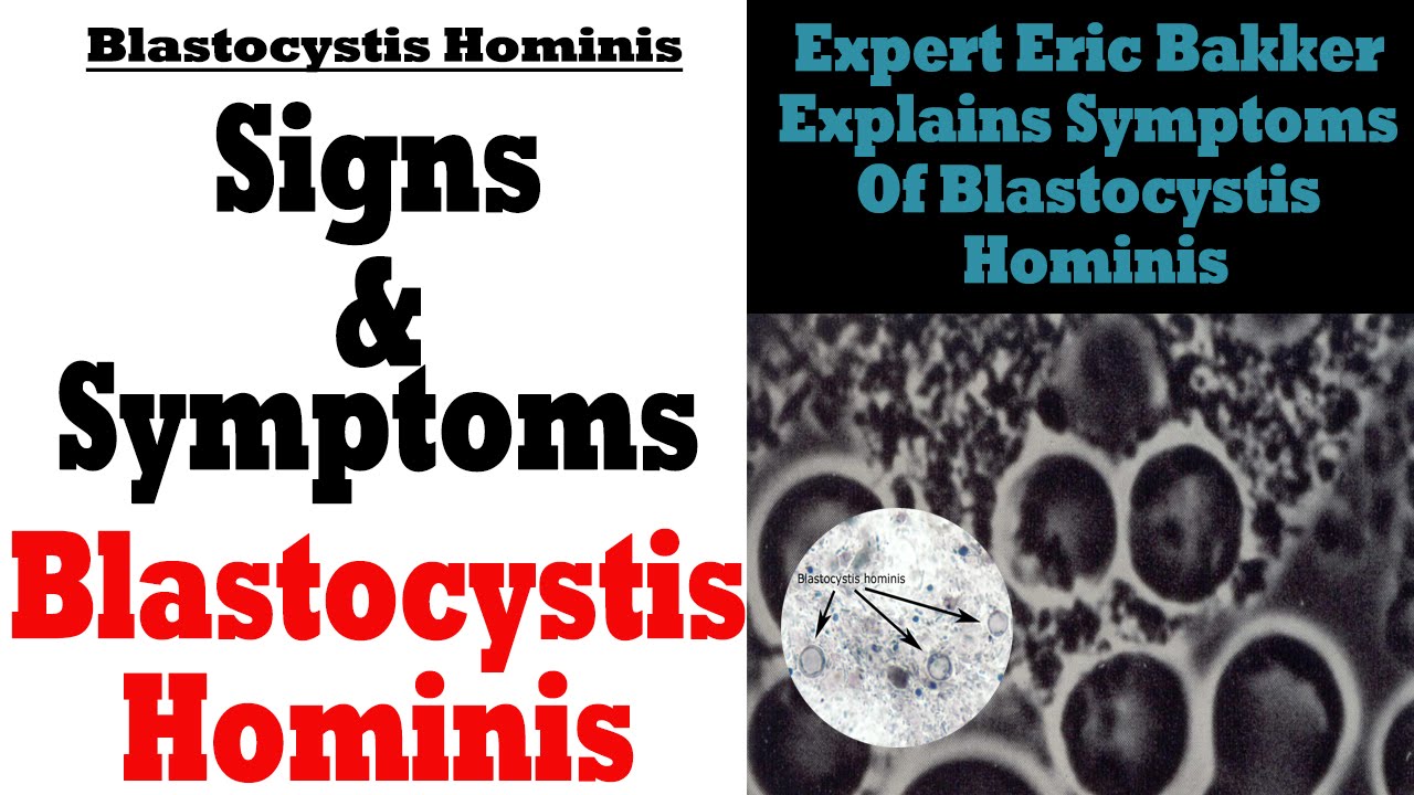 Blastocystis Hominis Histology Blastocystis Hominis