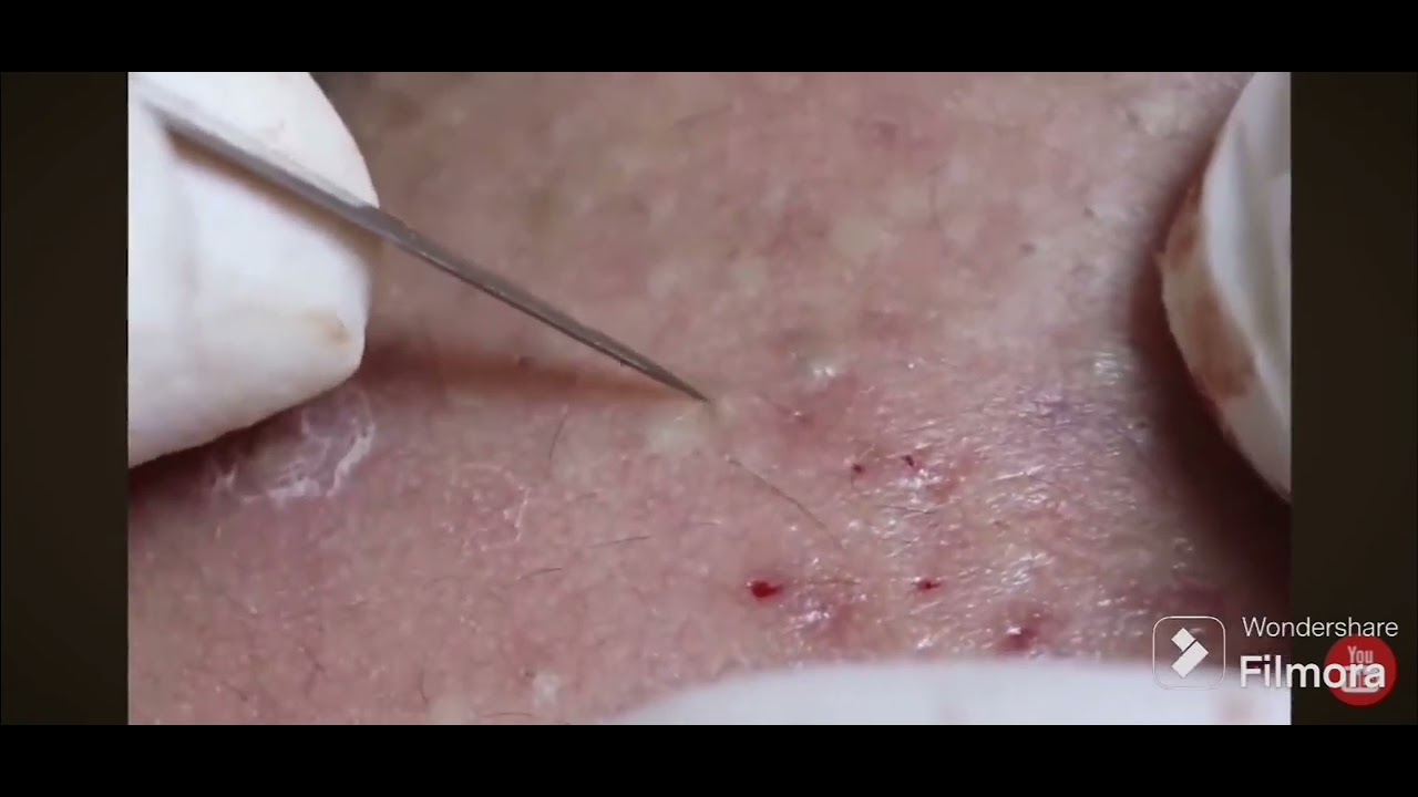 explosión acne# acné granos relax - YouTube