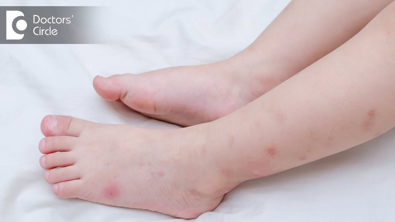 How to identify and manage bug bite marks? - Dr. Aruna Prasad - YouTube