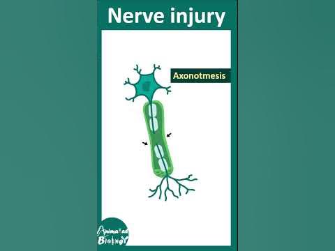 Types of nerve injury | neuropraxia | axonotmesis | neurotmesis | Wallerian degeneration | USMLE ...