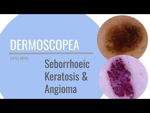 Little Bites : Dermoscopy of Seborrhoeic Keratosis and Angioma - YouTube
