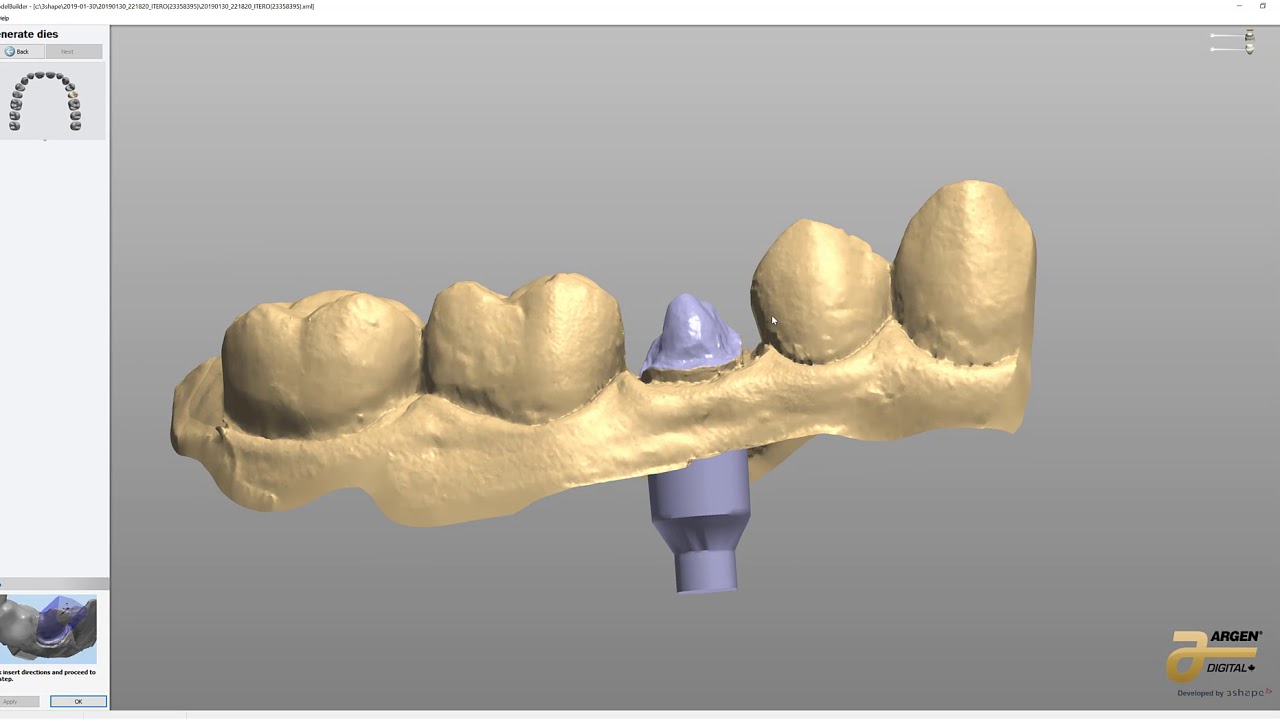 3Shape iTero case through model builder. - YouTube