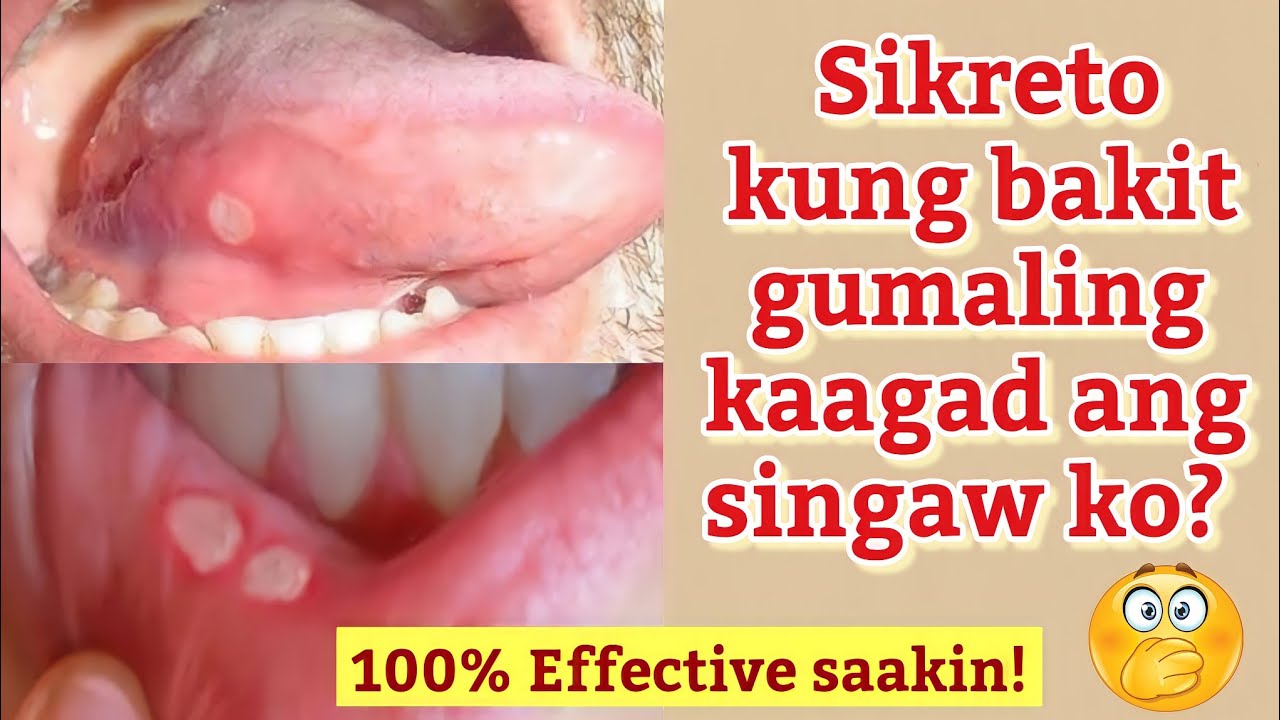 ITO LANG NAKAPAG-PAGALING NG MABILIS SA SINGAW KO💡| LUNAS SA SINGAW ...