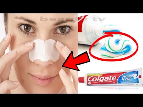 Sadece 5 Dakikada BLACKHEADS'i Diş Macunu Diş Macunu ile Çıkarmanın En İyi Yolu BLACKHEADS'i