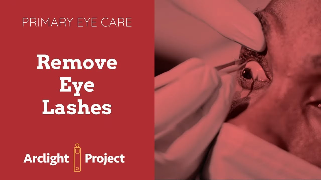 How to remove an eye lash: Arclight Project, WHO Primary Eye Care - YouTube