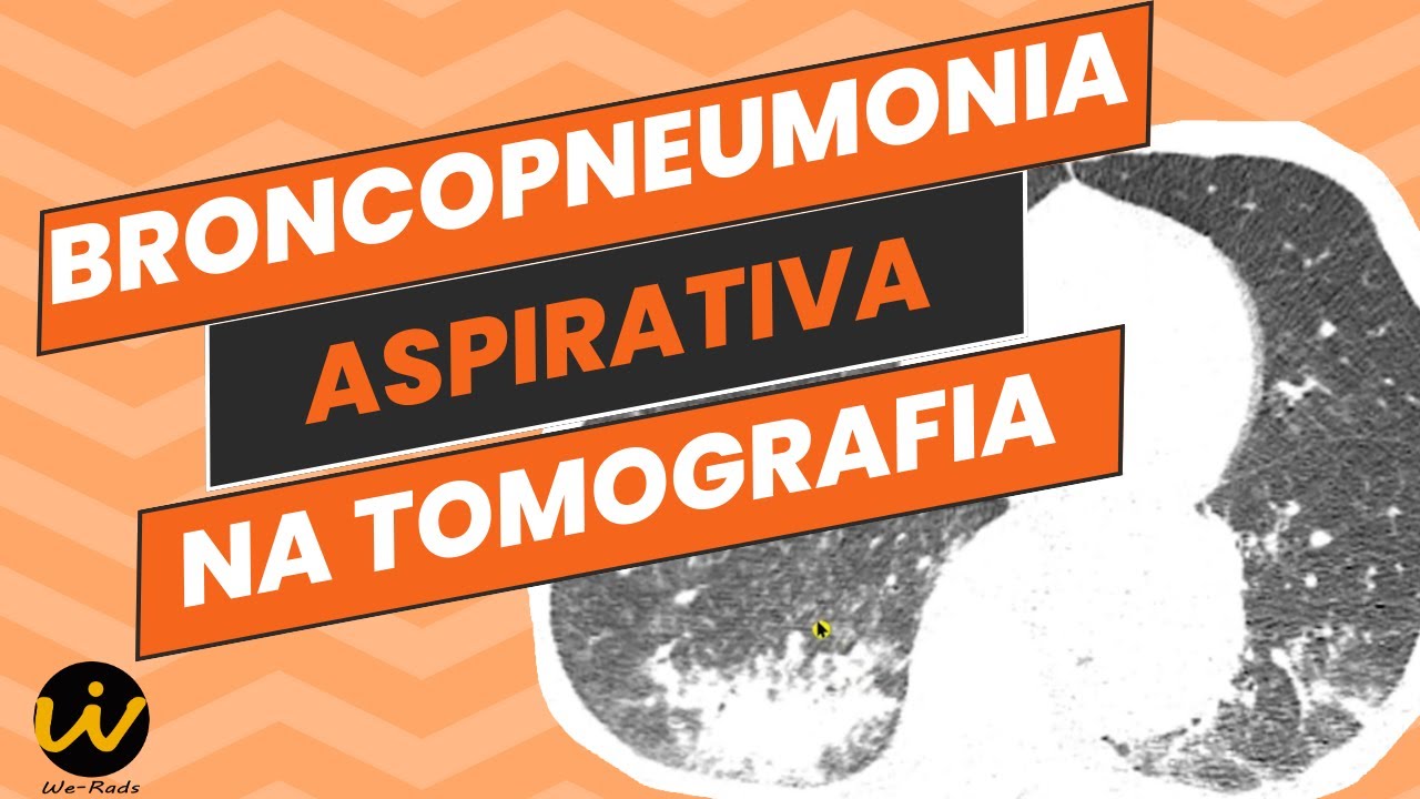 BRONCOPNEUMONIA ASPIRATIVA na Tomografia Computadorizada de TÓRAX - YouTube