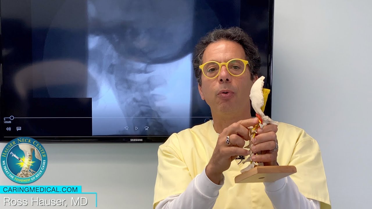 C1 nerve root compression: C0-C1 instability. Digital Motion X-ray (DMX ...