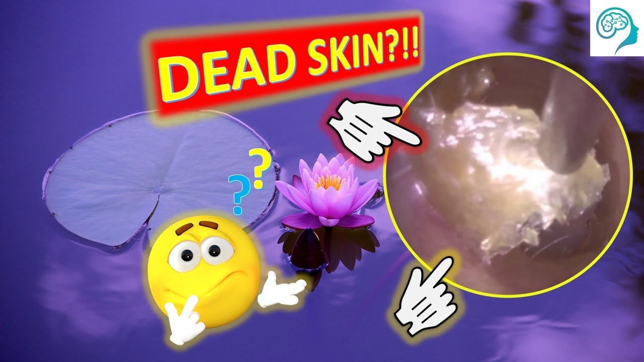 The fastest way to eliminate an dead skin in ear canal. - YouTube