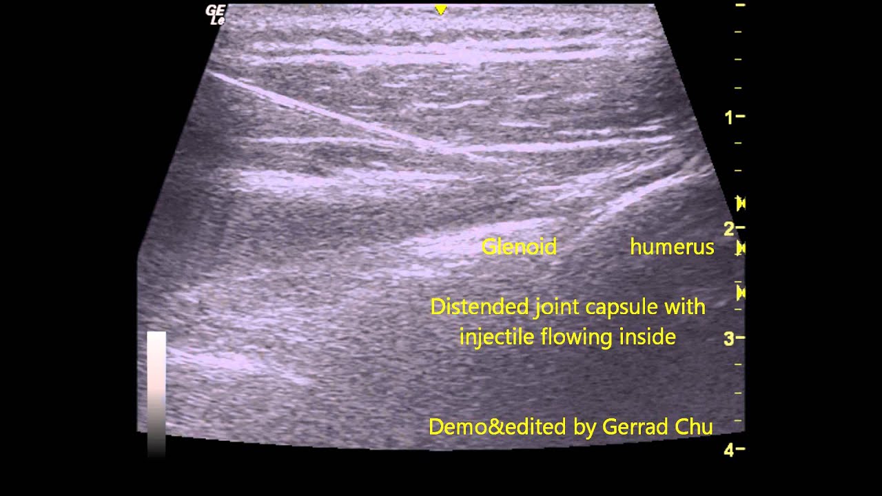Sonoguided glenohumeral joint IA injection - YouTube