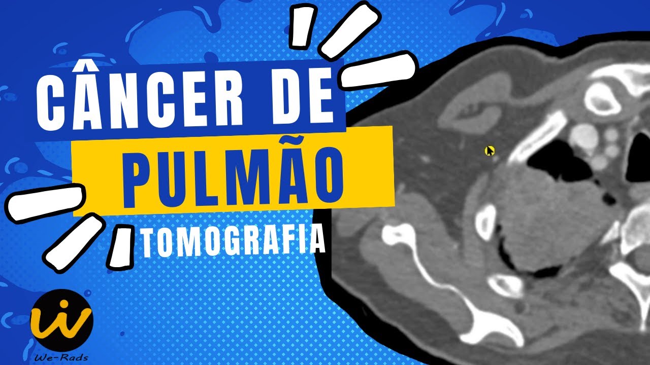 CÂNCER de PULMÃO no Ápice Pulmonar - Tomografia Computadorizada de ...