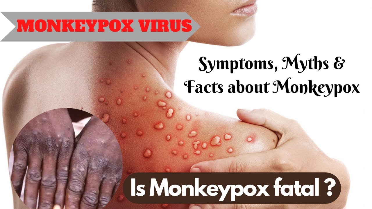 What is Monkeypox | Myths & Facts About Monkeypox | Common Symptoms of ...