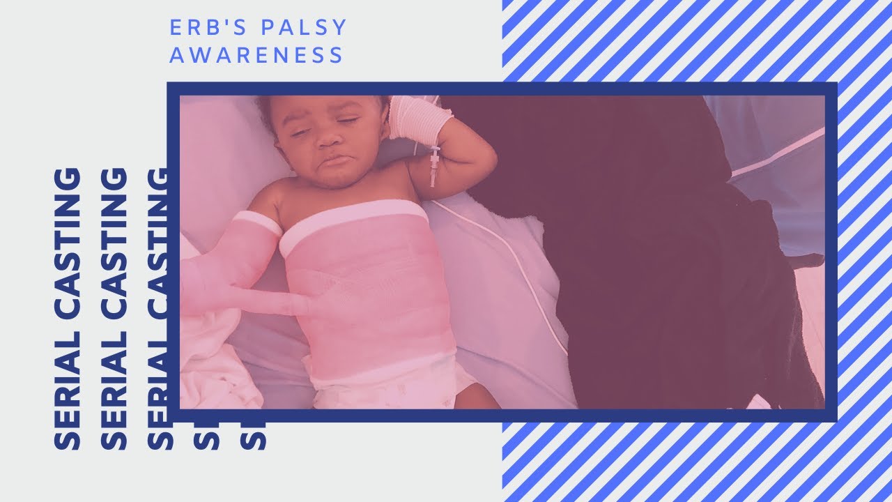 BRACHIAL PLEXUS INJURY / ERB'S PALSY SERIAL CASTING (10/28/2019) | THE ...