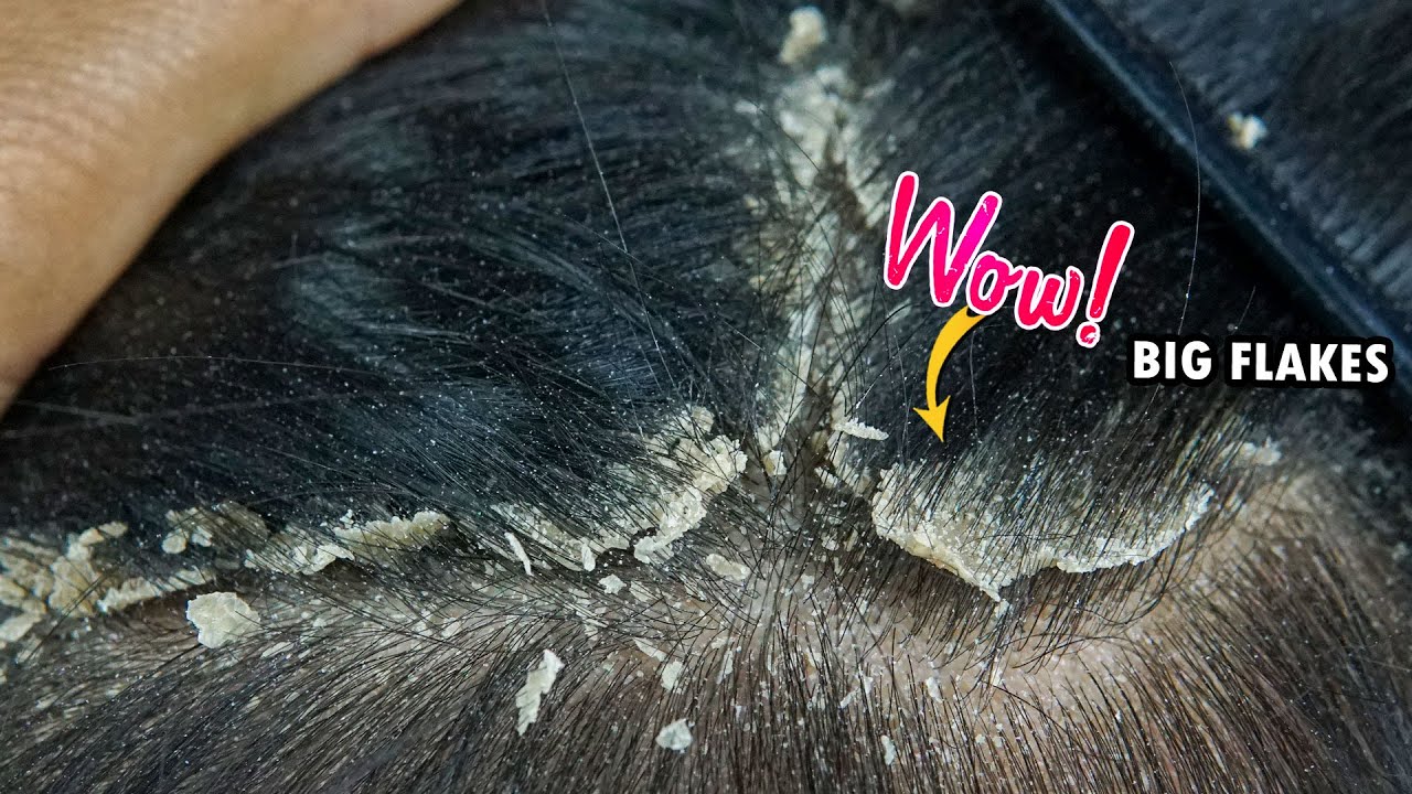 Dandruff Scratching Big Flakes Close Up #1038 - YouTube
