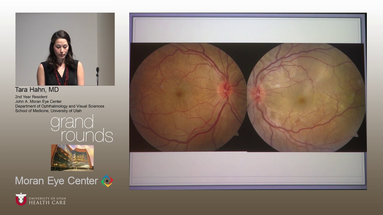 A Case of Drug Induced Uveitis - YouTube