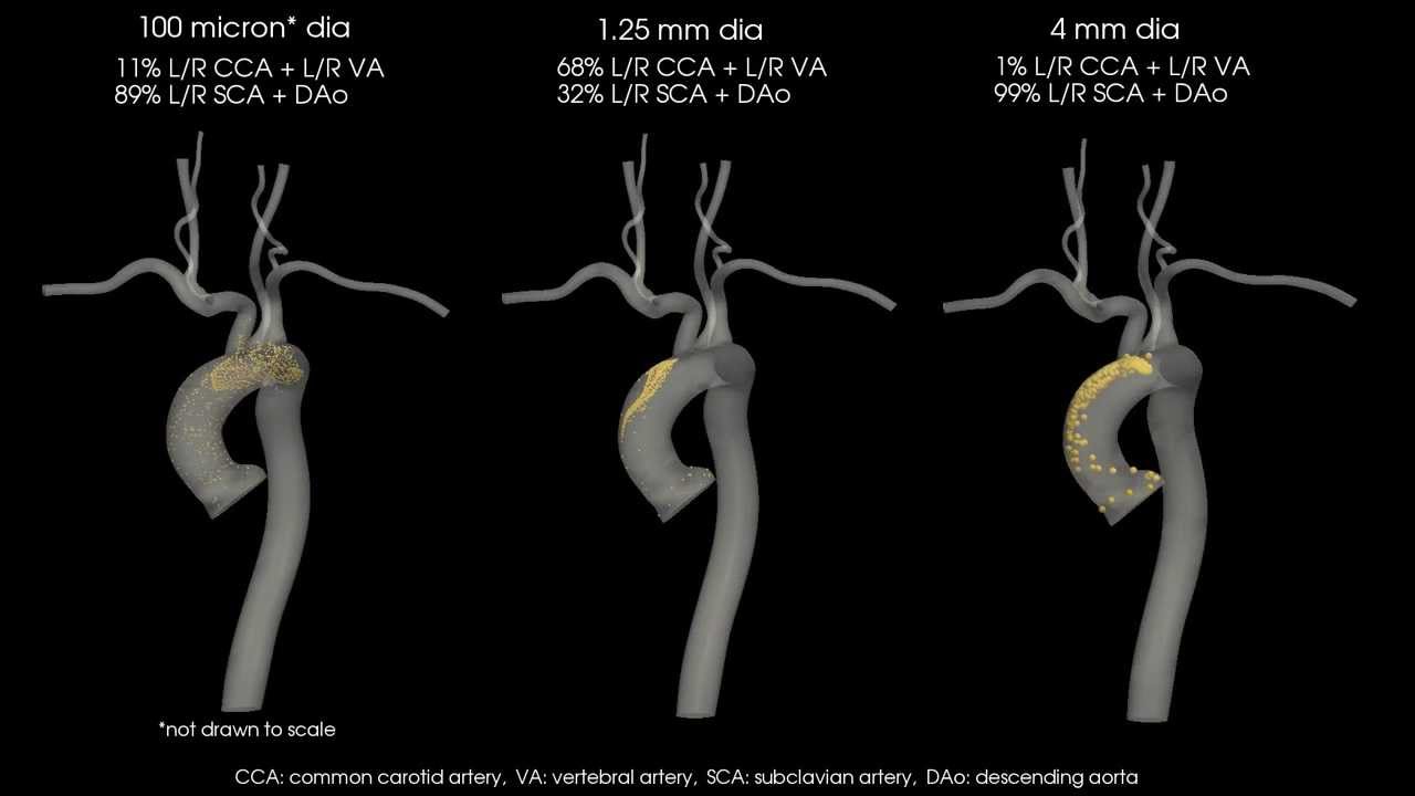 Size-dependent predilection of cardiogenic emboli to the head - YouTube
