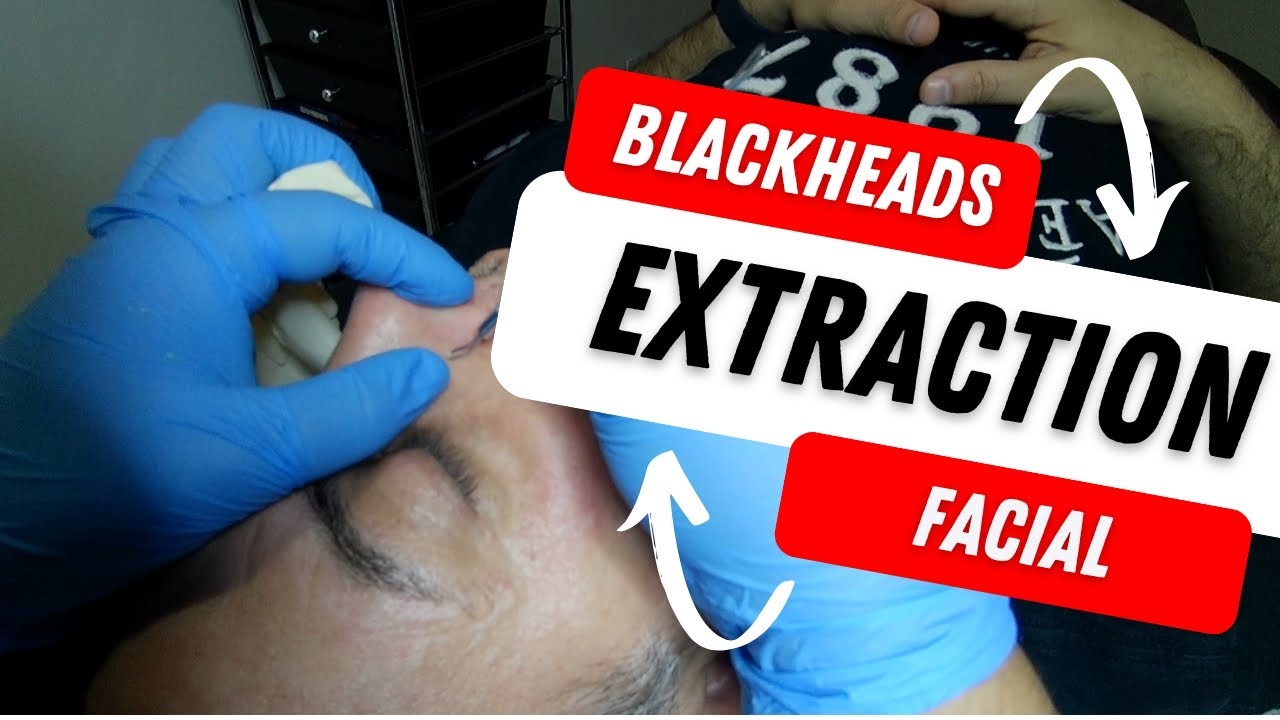 Best Facial Extractions In West Palm Beach | Removing Fat Deposits And ...