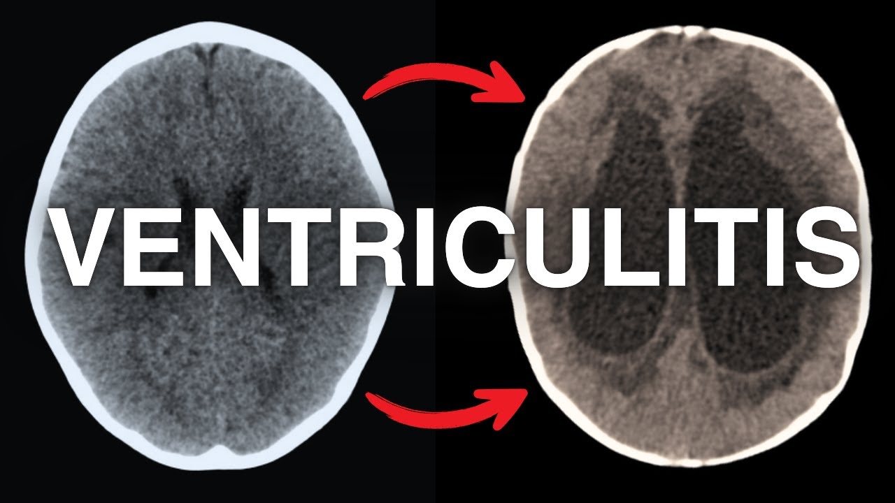 Ventriculitis Explicado Claramente - YouTube