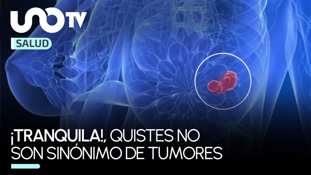 Mes contra cáncer de mama: ¡Tranquila!, quistes no son sinónimo de ...
