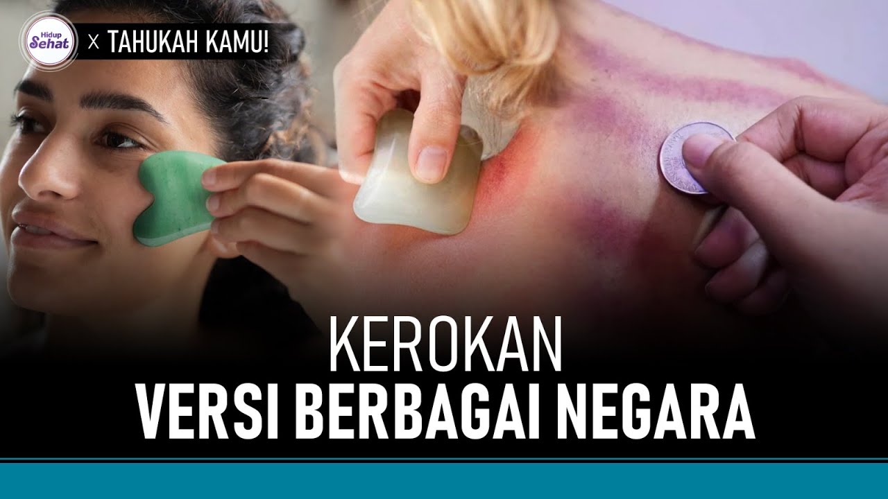 Budaya Kerokan Ternyata Gak Hanya di Indonesia! | Hidup Sehat tvOne ...