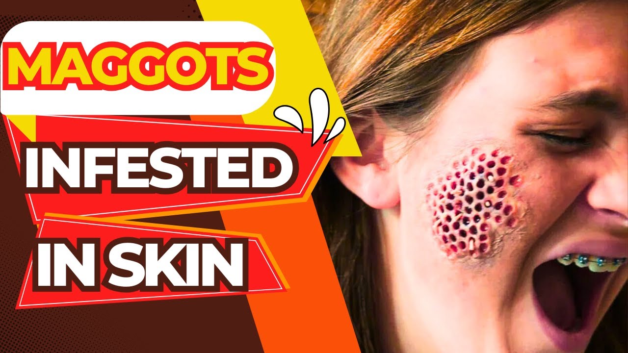 maggots infested skin | cutaneous skin myiasis and trypophobia causes ...