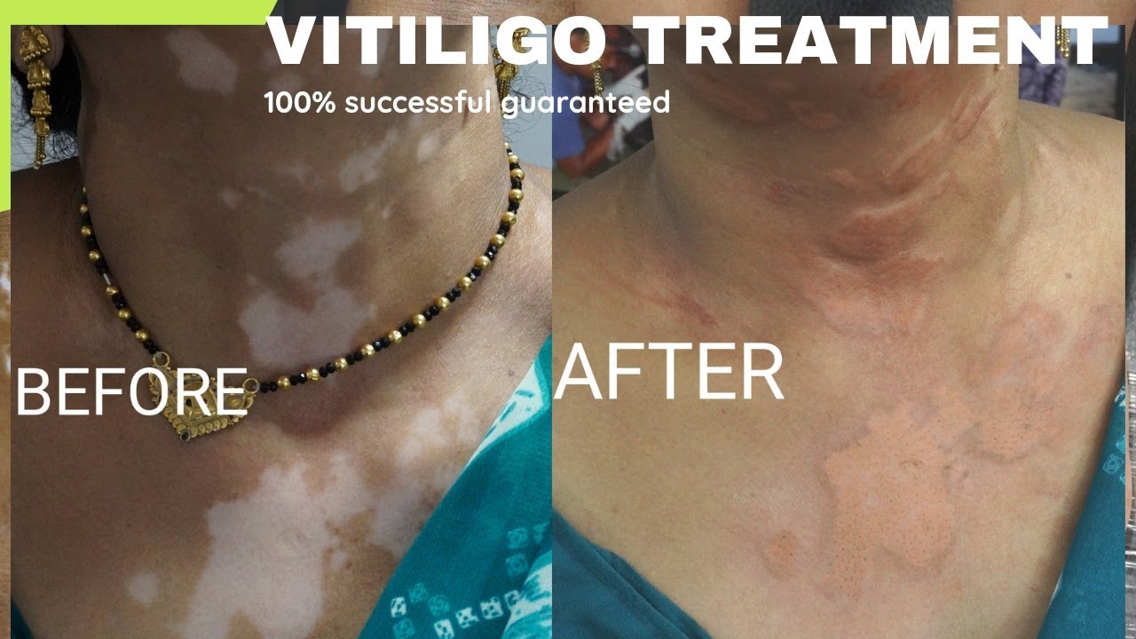 VITILIGO TATTOO COVER-UP / VITILIGO PERMANENT TREATMENT / COVERING ...