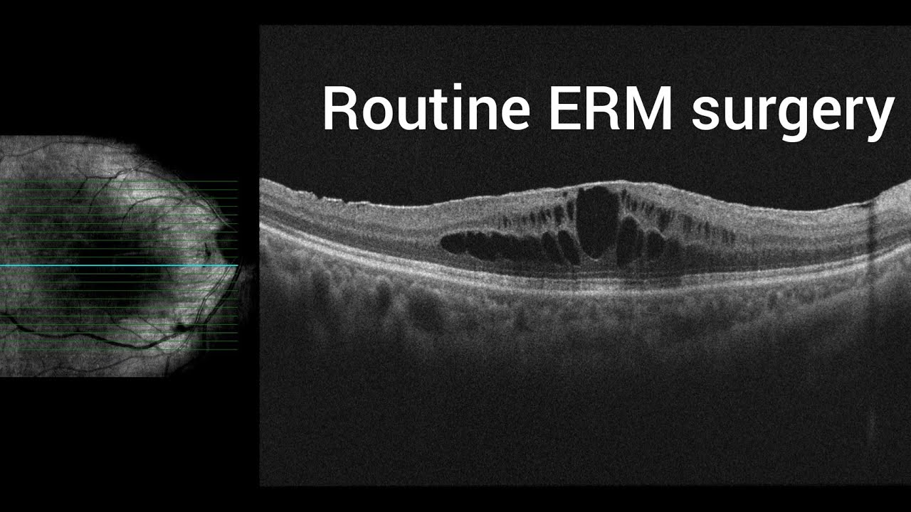 Routine ERM surgery 망막전막 수술 (22.2.15) - YouTube