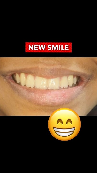 Reinvent your Smile, Smile design with braces.#dentist #dental #beforeafter - YouTube