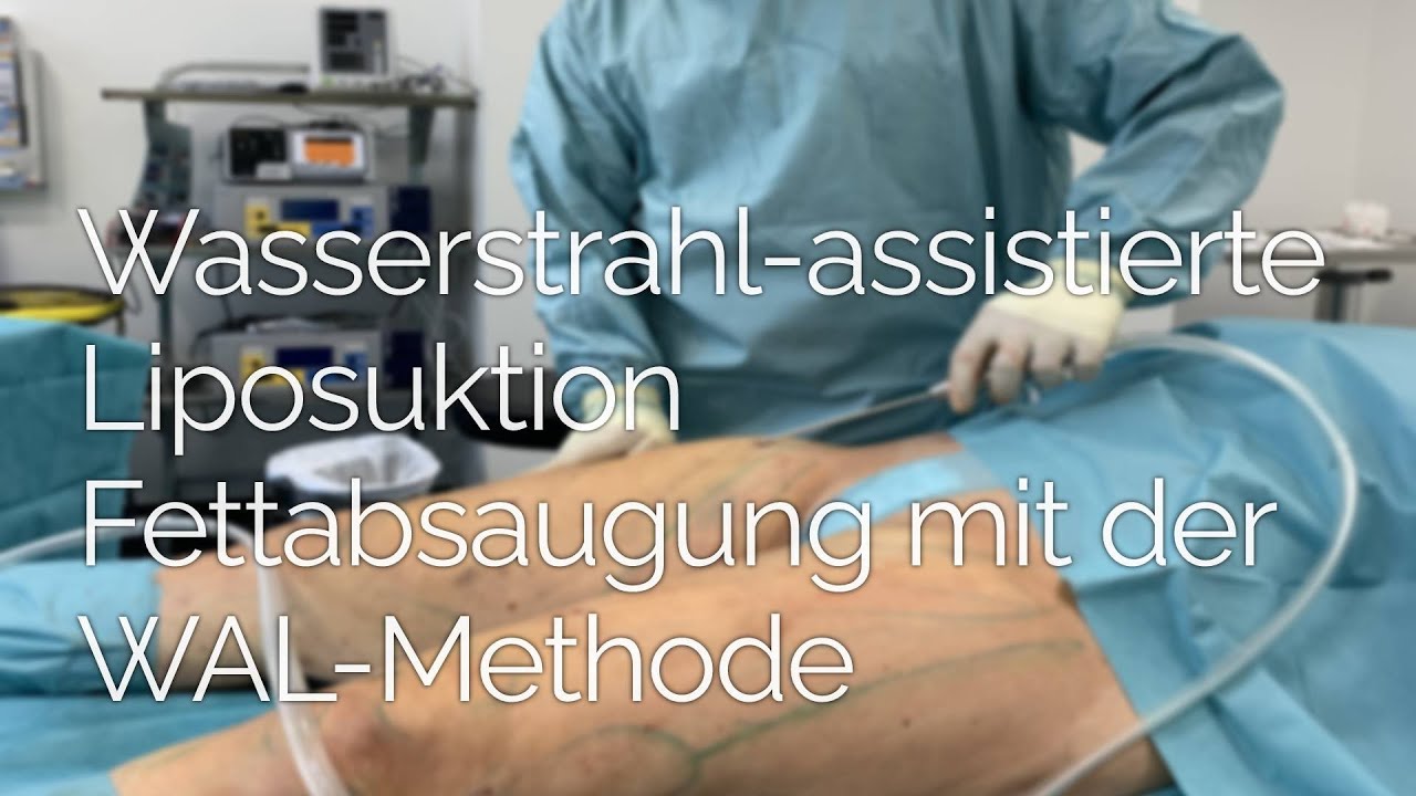 Wasserstrahl-assistierte Liposuktion - Fettabsaugung mit der WAL ...