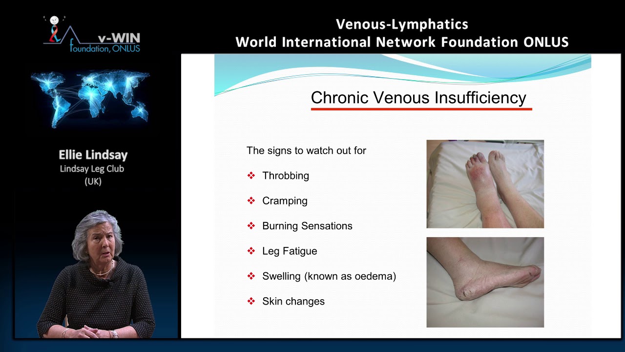 Public venous awareness - E. LINDSAY - vWIN foundation - YouTube