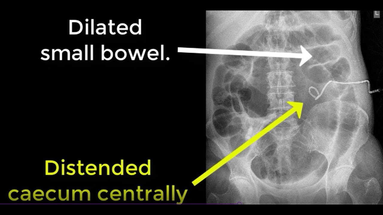 Sigmoid and caecal volvulus. - YouTube