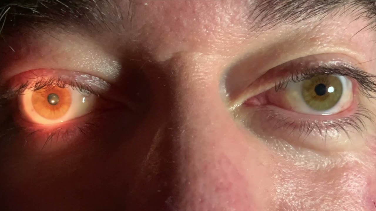 Examen de pupilas - YouTube