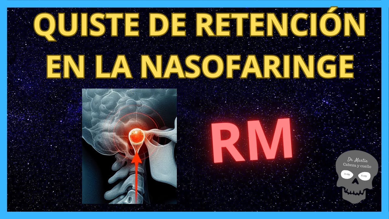 QUISTE DE RETENCIÓN del espacio MUCOSO FARÍNGEO 👉 Resonancia Magnética ...