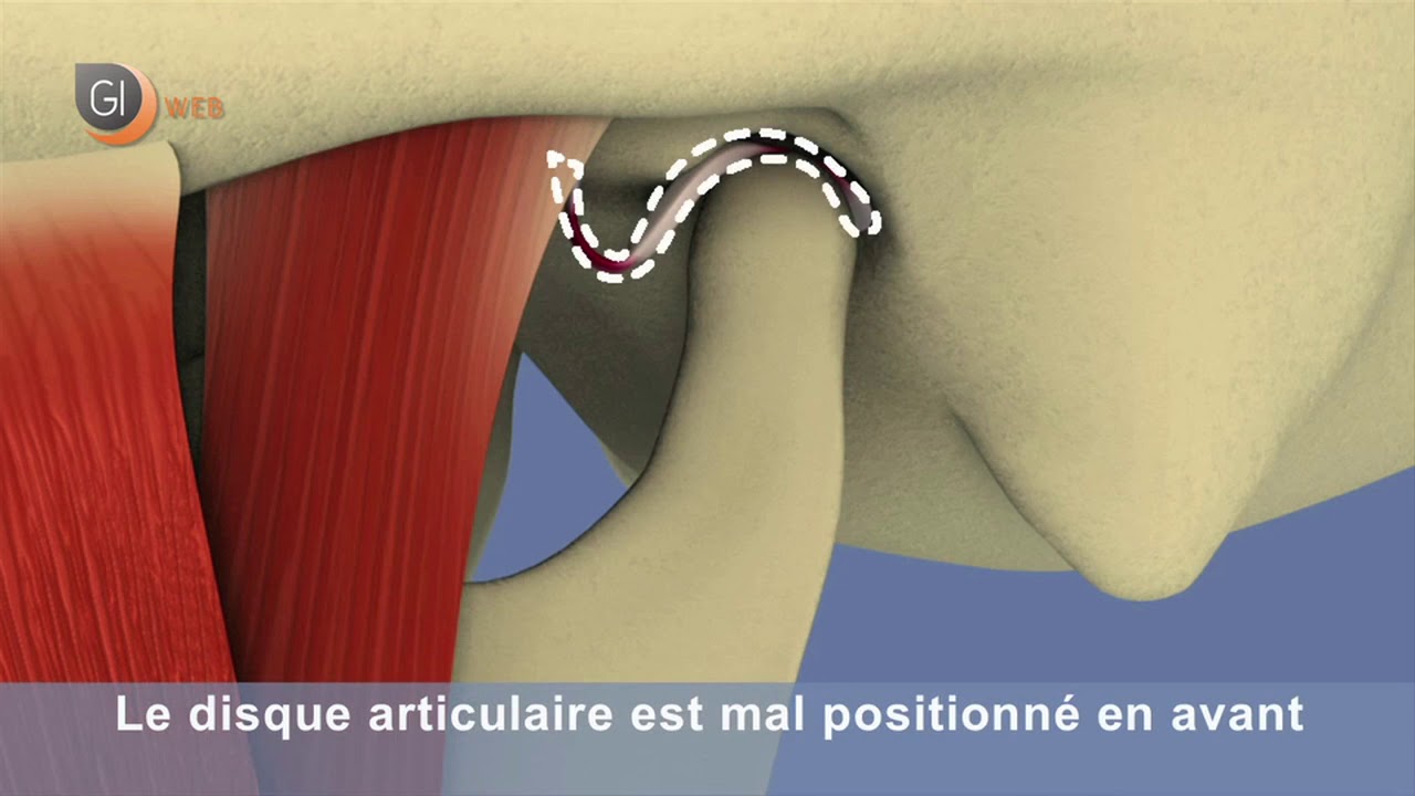 ATM luxation reeductible - YouTube