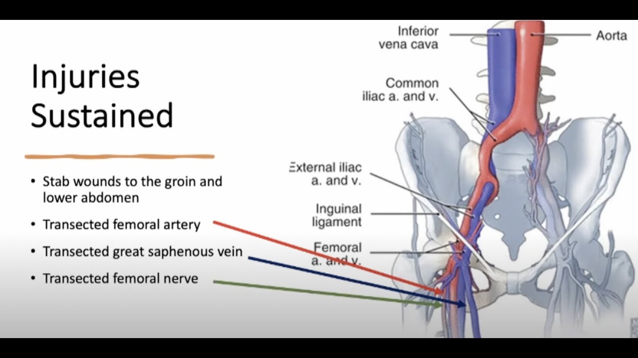 Managing Junctional Hemorrhage - Reel Emergency Episode 11 - YouTube