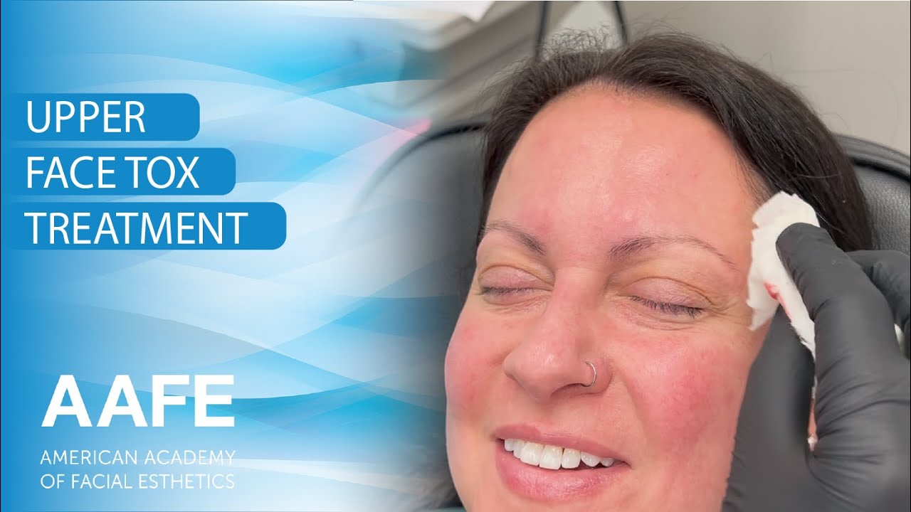 Upper Face Tox Treatment - YouTube