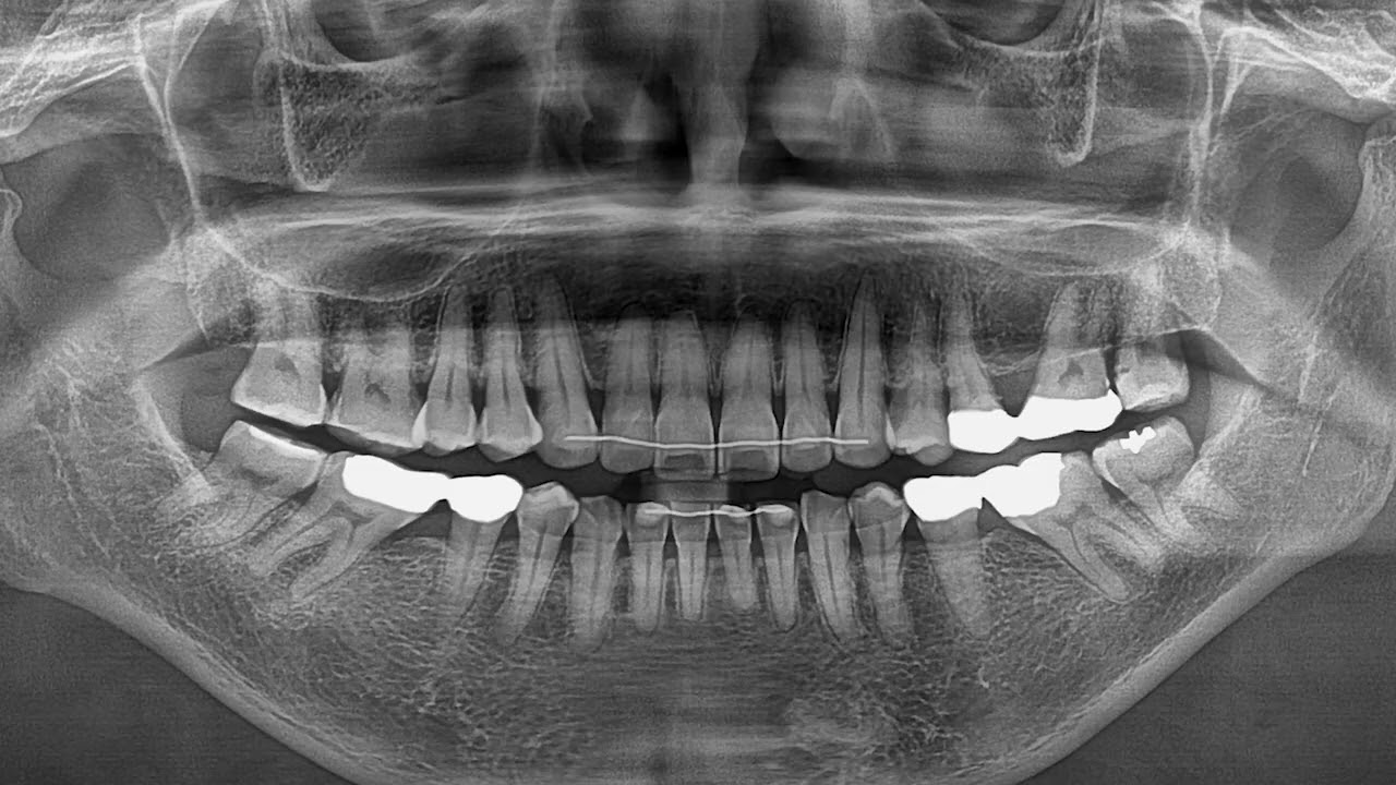 Dentium bright CT Clinic Case - YouTube