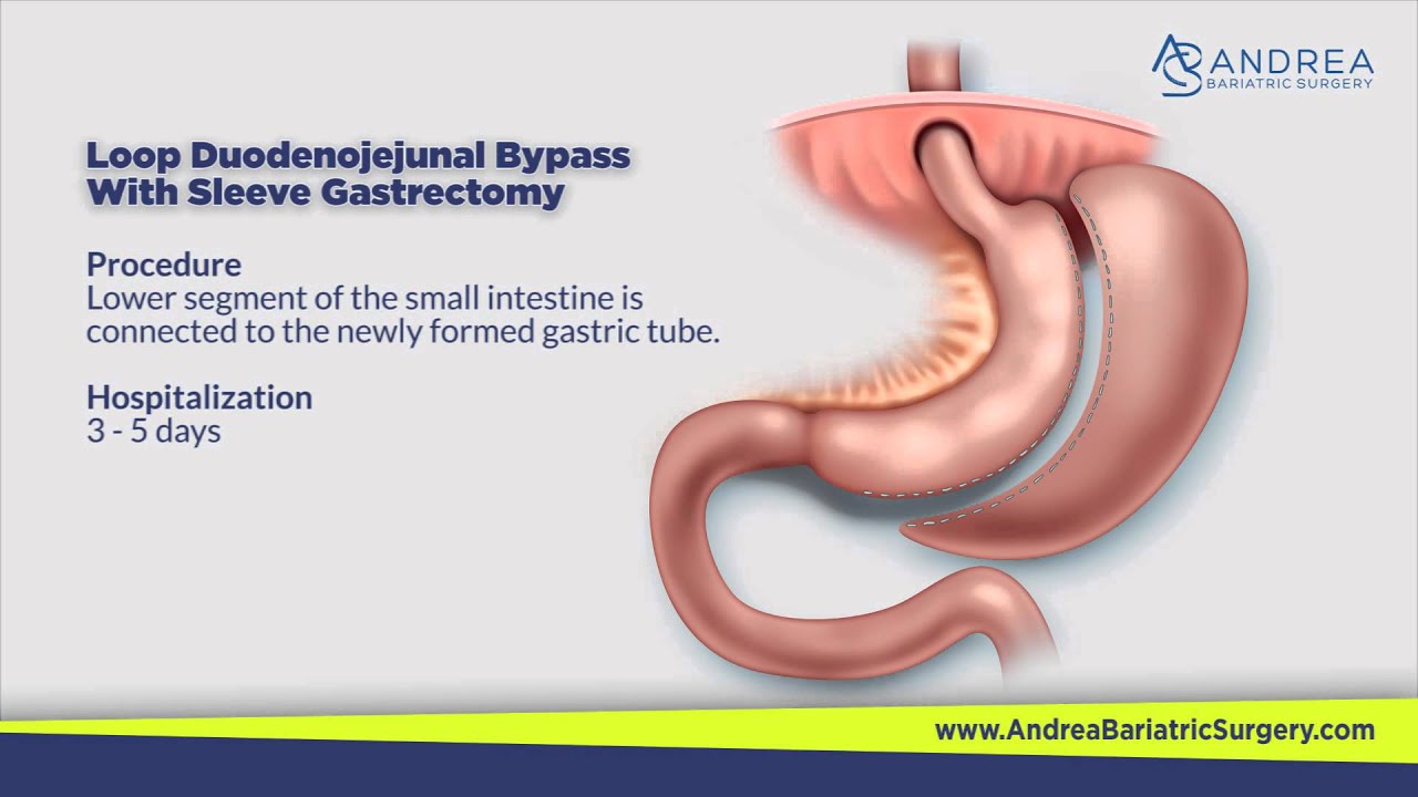 Loop Duodenojejunal Bypass With Sleeve Gastrectomy Andrea Bariatric loop-duodenojejunal-bypass-with-sleeve-gastrectomy-andrea-bariatric